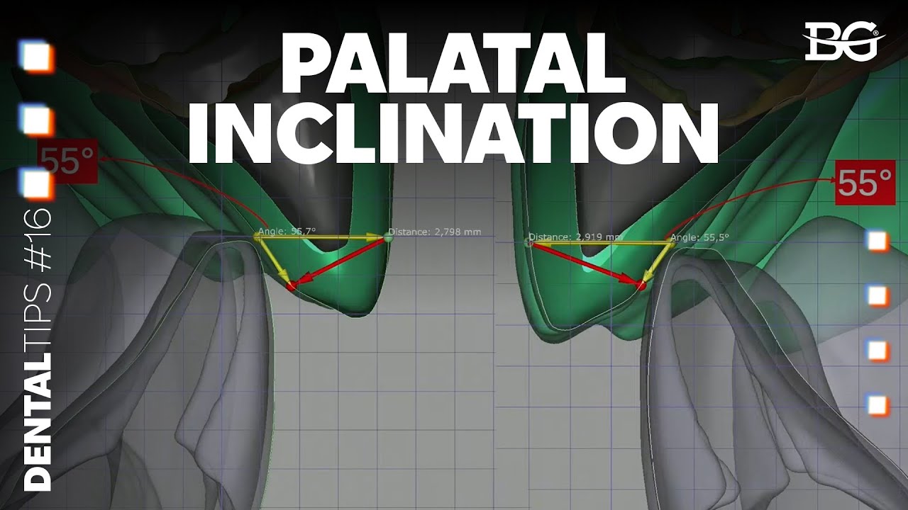 How the palatal angle affects tooth function - YouTube