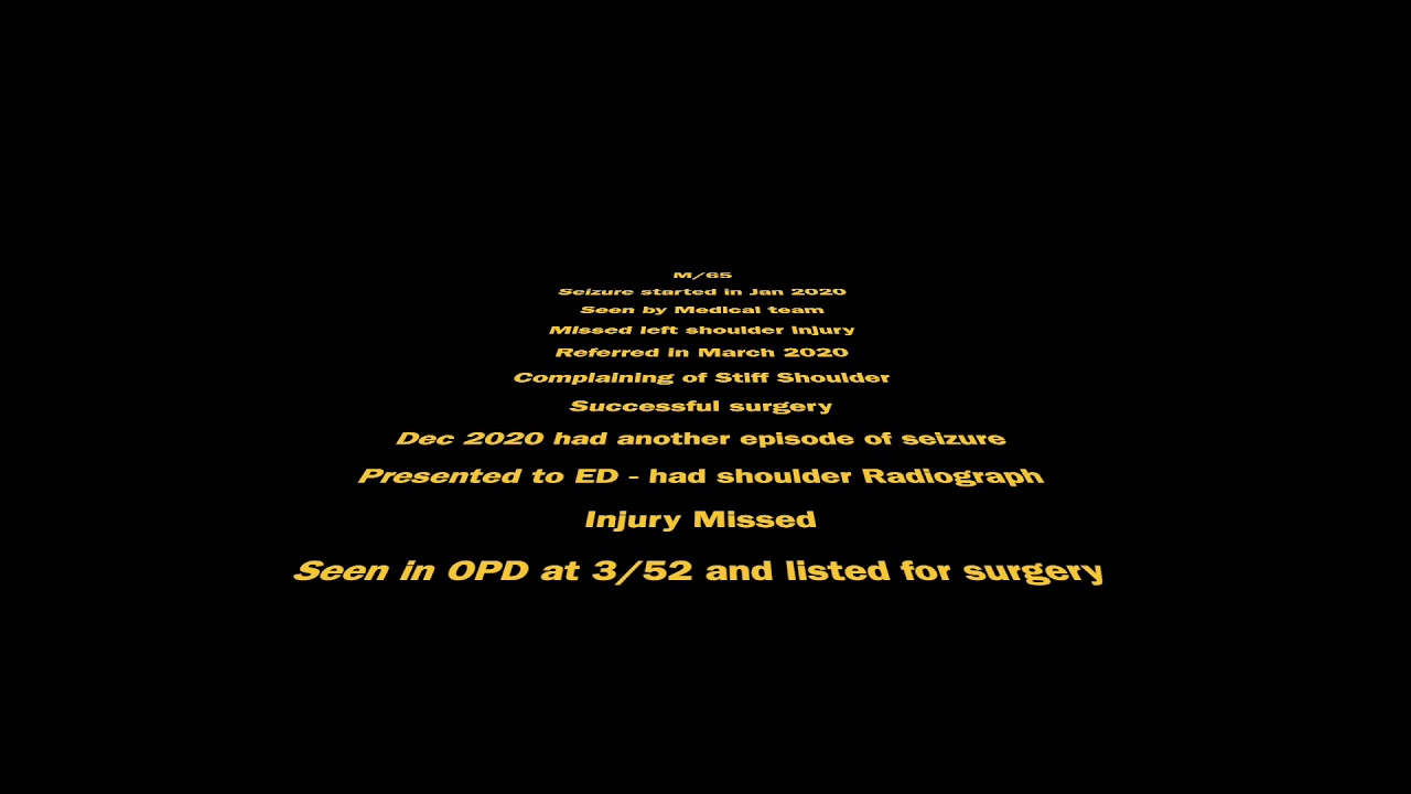 Modified Mclaughlin Procedure for locked posterior dislocation Shoulder ...