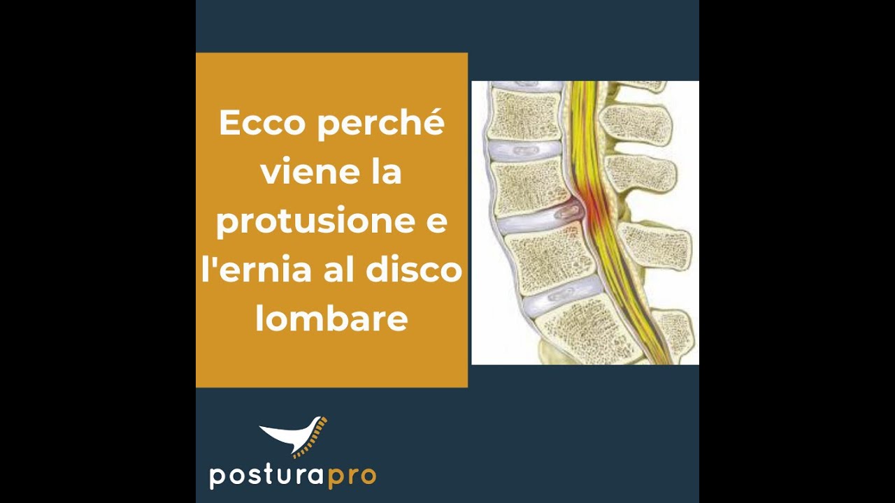 Ecco perchè viene l'ernia e la protusione al disco lombare - YouTube