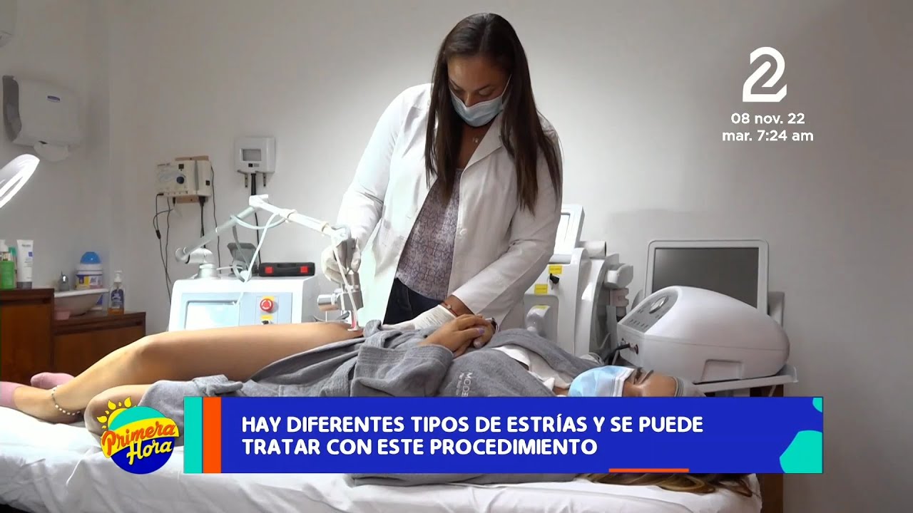 Tratamiento con laser Co2 para estrías - YouTube