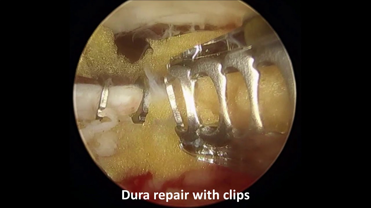 Endoscopic dura repair - YouTube