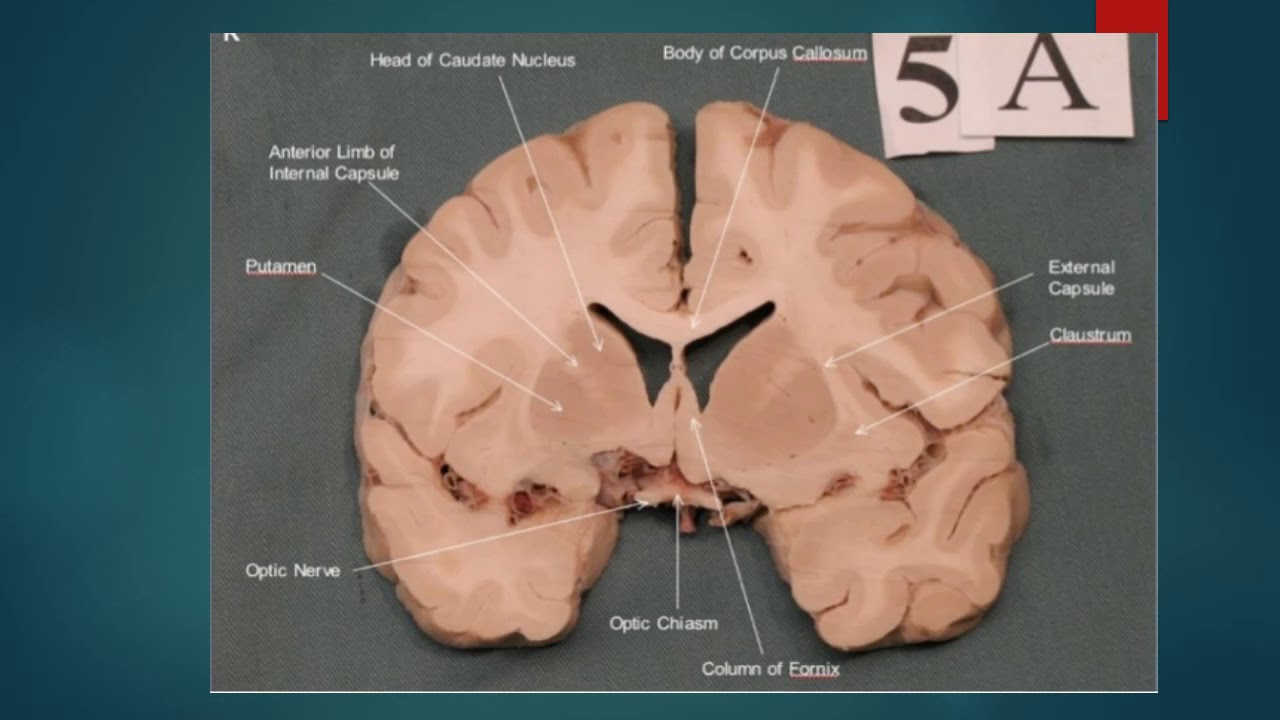 Horizontal and Coronal sections of The Brain - YouTube