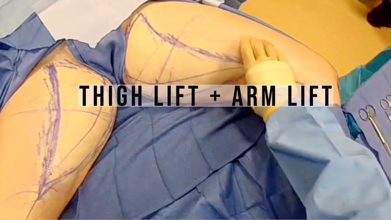 Dr Repta Performs A Thigh Lift And Arm Lift Youtube