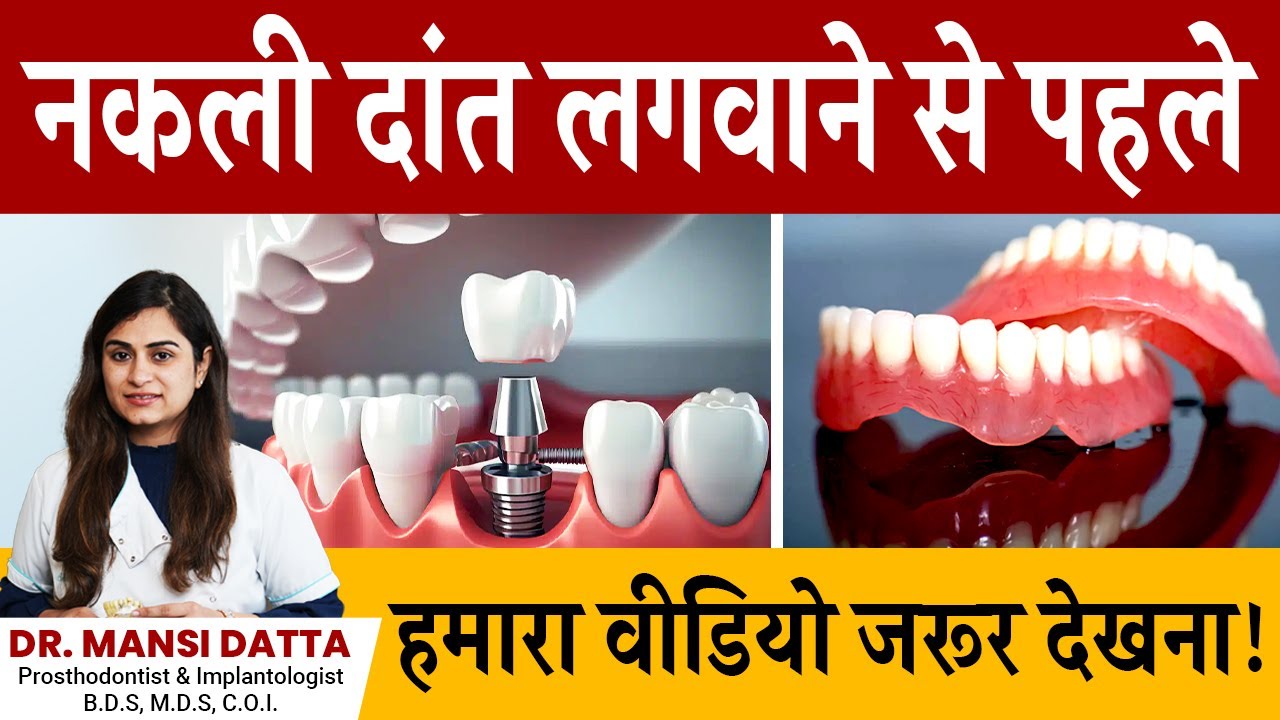 नकली दांत लगवाने से पहले हमारा वीडियो जरूर देखना! | Dental Implant ...
