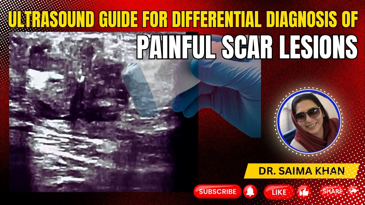 Ultrasound Guide for Differential Diagnosis of painful Scar Lesions # ...