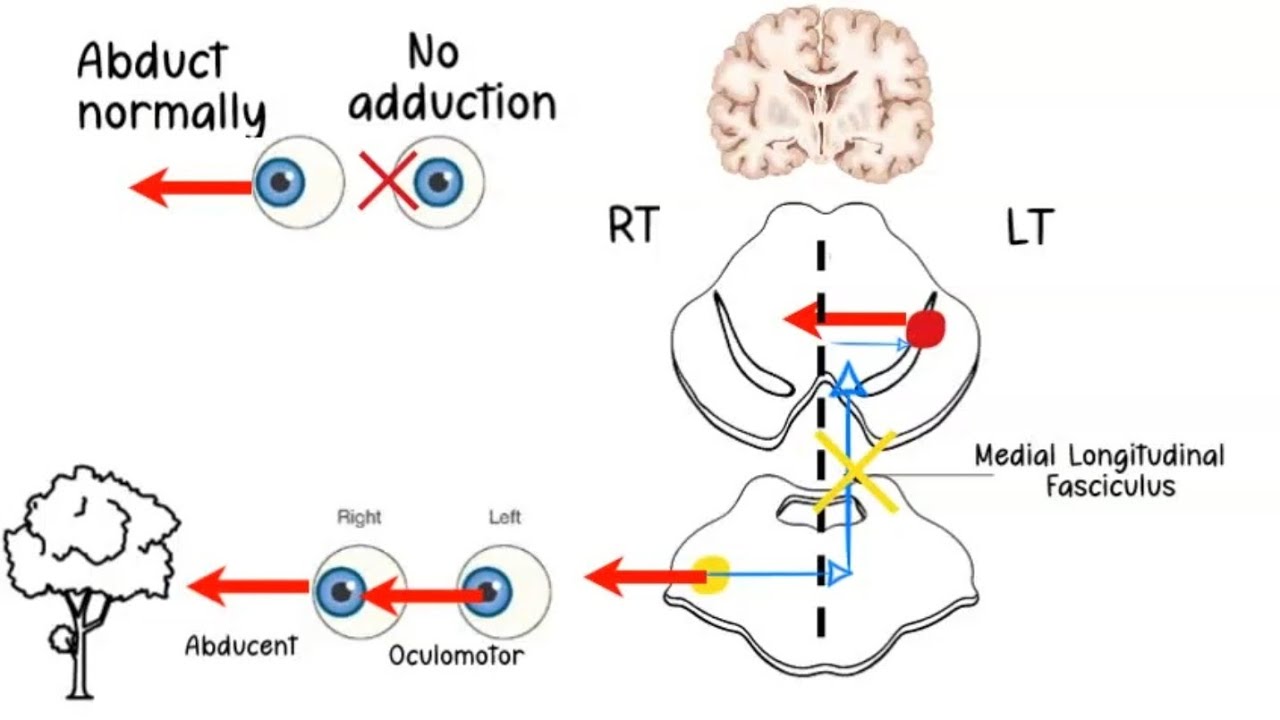 Internuclear Ophthalmoplegia INO ( one and half / eight and half syndrome) - YouTube