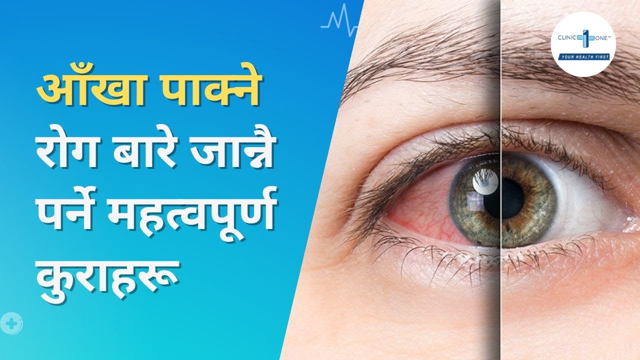 Viral Conjunctivitis अर्थात आँखा पाक्ने रोग बारे जान्नै पर्ने ...