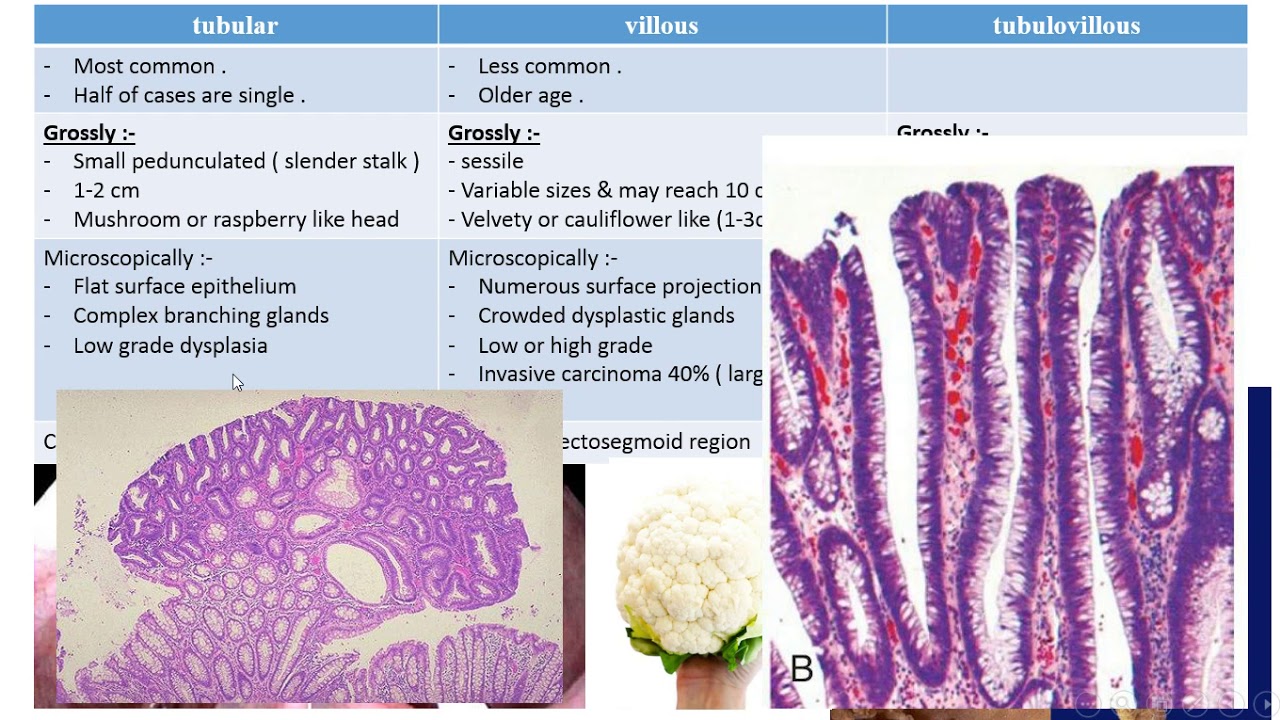 tumors of lower GIT - YouTube