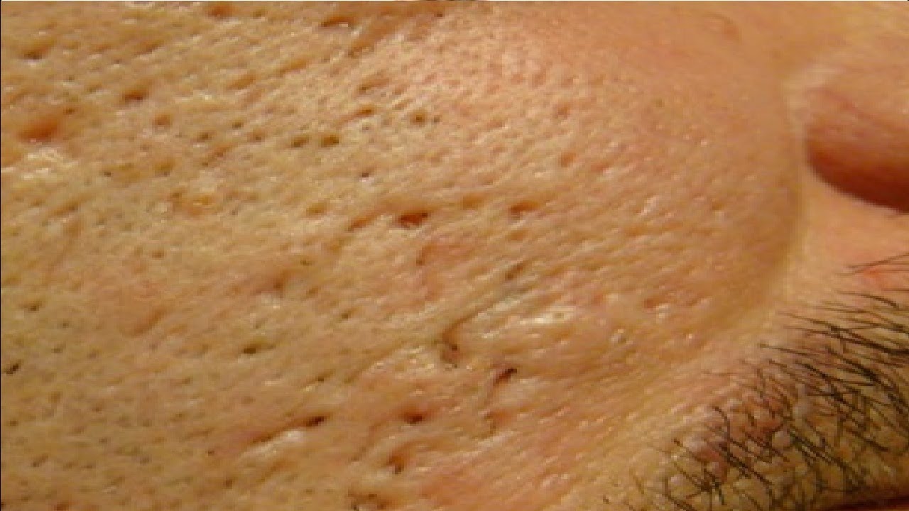 how to get rid of holes in your face naturally - YouTube