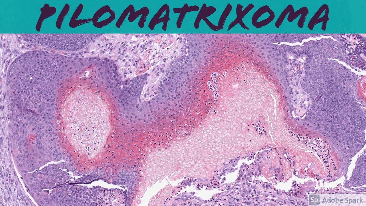 Pilomatricoma Histology