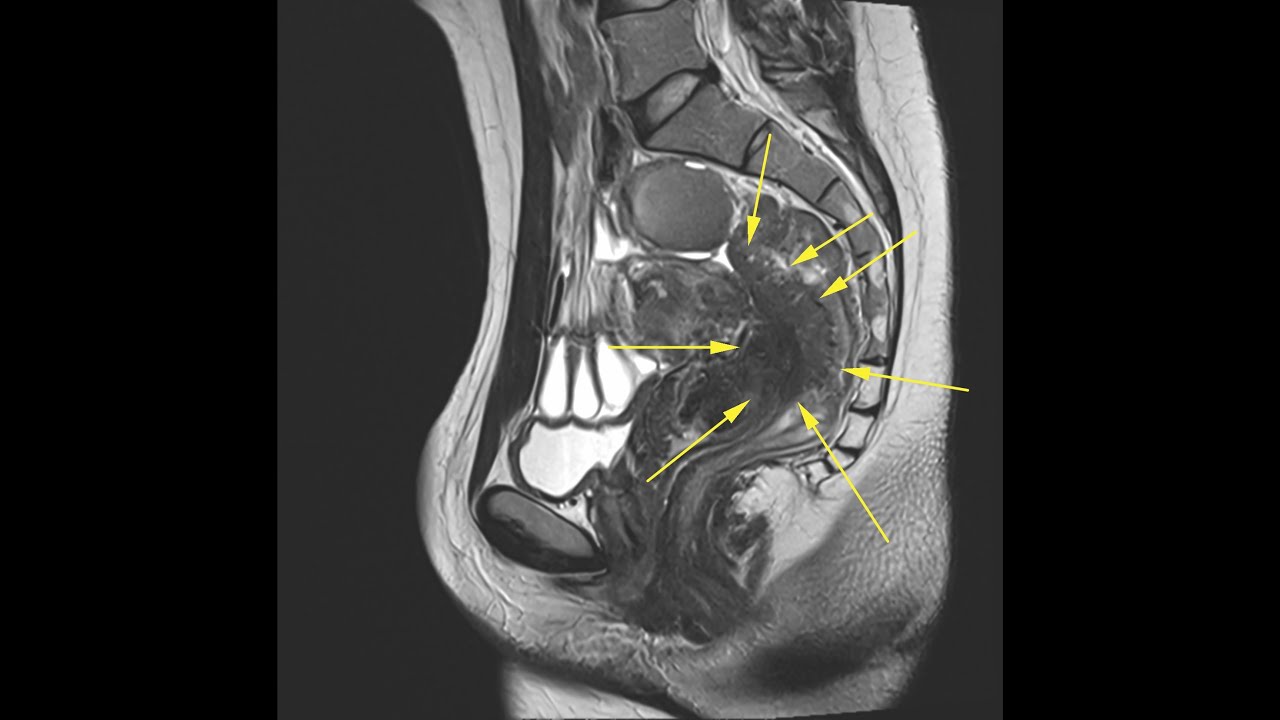 Huge deep endometriosis involving low rectum, vagina, left parametrium ...