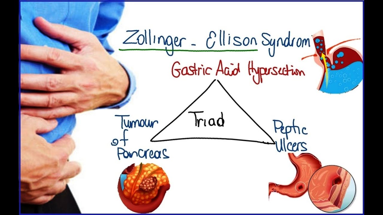 Zollinger ellison syndrome Gastrinoma in the pancreas; caused by ...