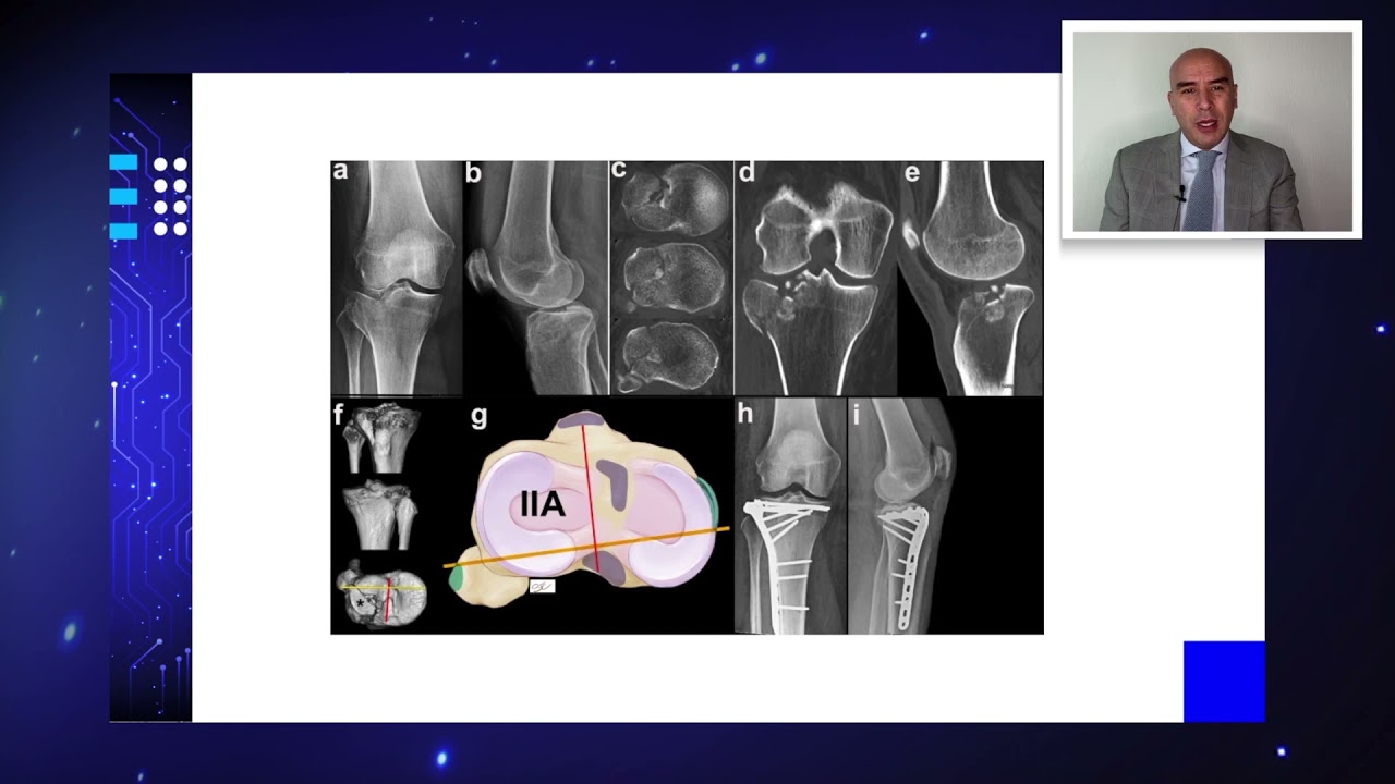Fractura de platillos tibiales. Reducción y fijación - YouTube