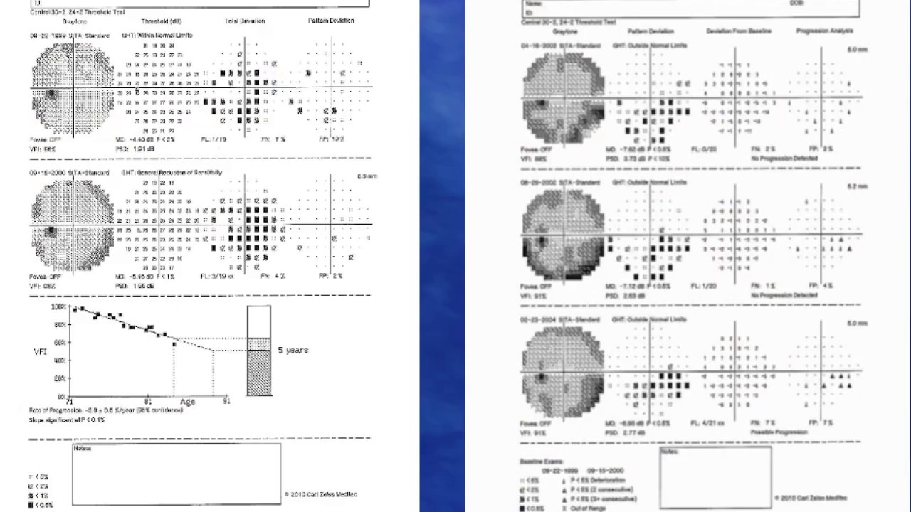 Field progression : which method to use? part 2 (Event analysis) - YouTube