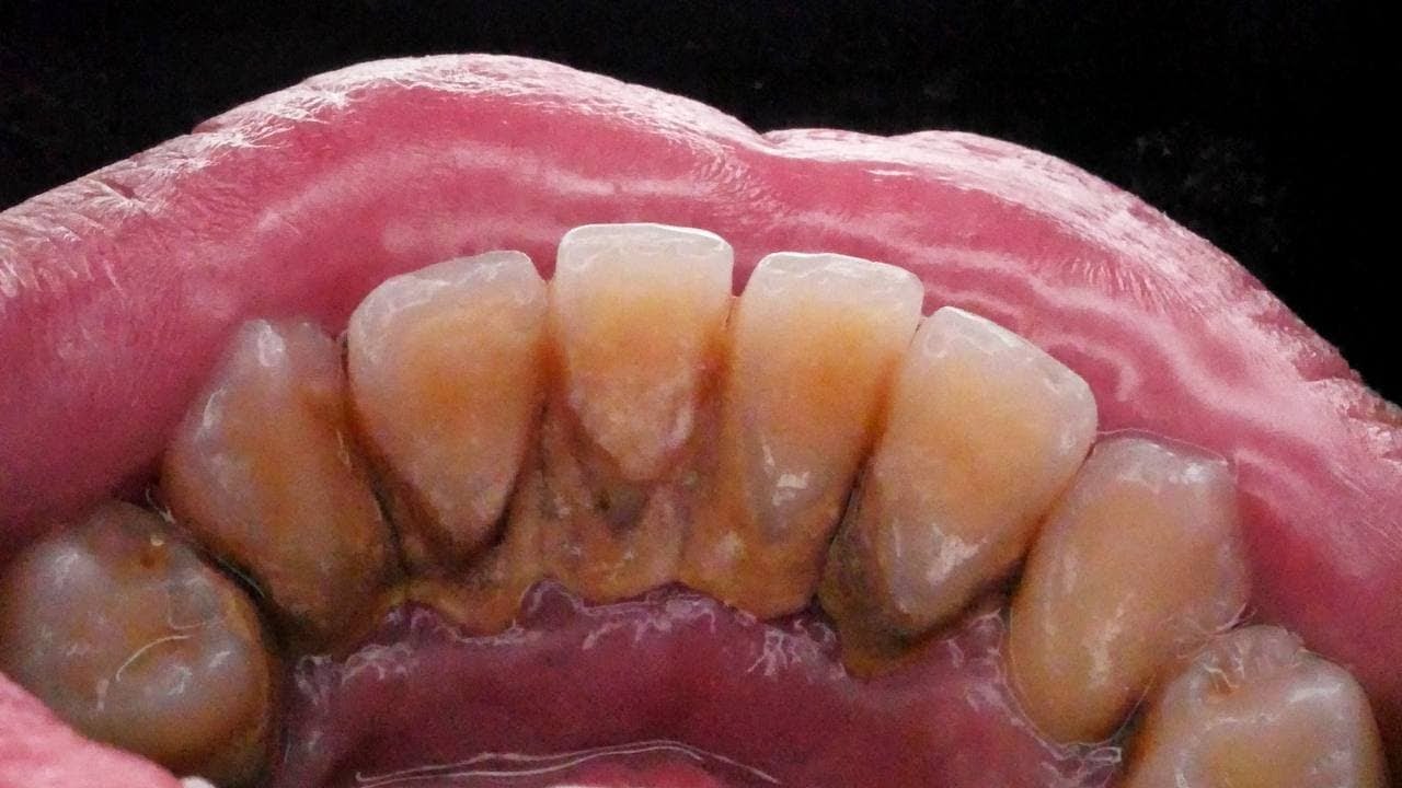 SCALING TARTAR | Dentist | Dokter Gigi Tri Putra - YouTube