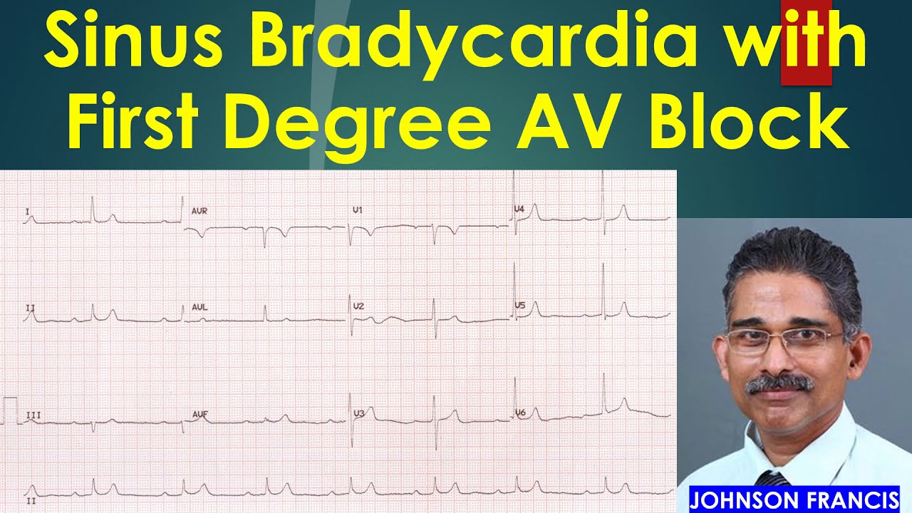 First Degree Av Block First Degree Av Block