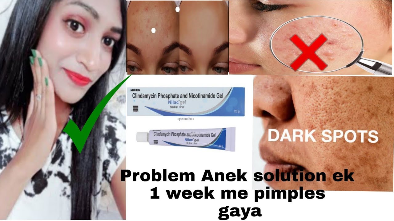 1 week me pimples gayab most powerful Nilec gel crem 100% effective ...
