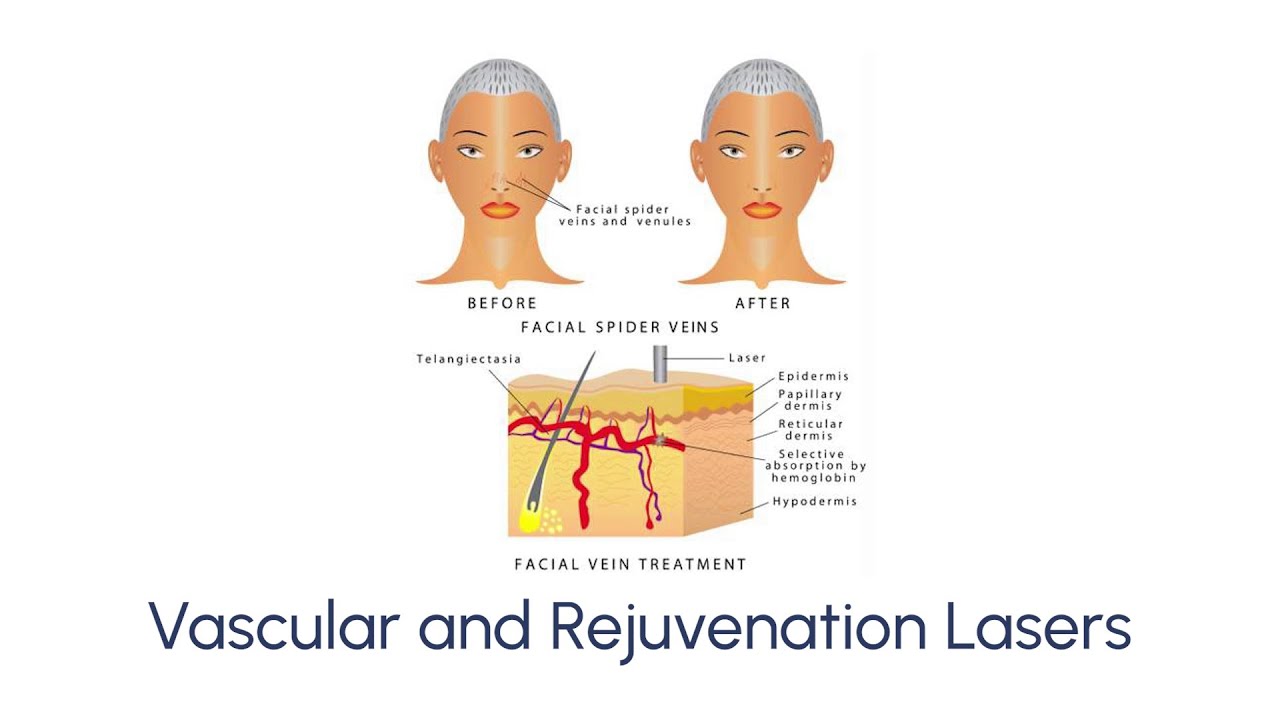 Introduction to Lasers - YouTube
