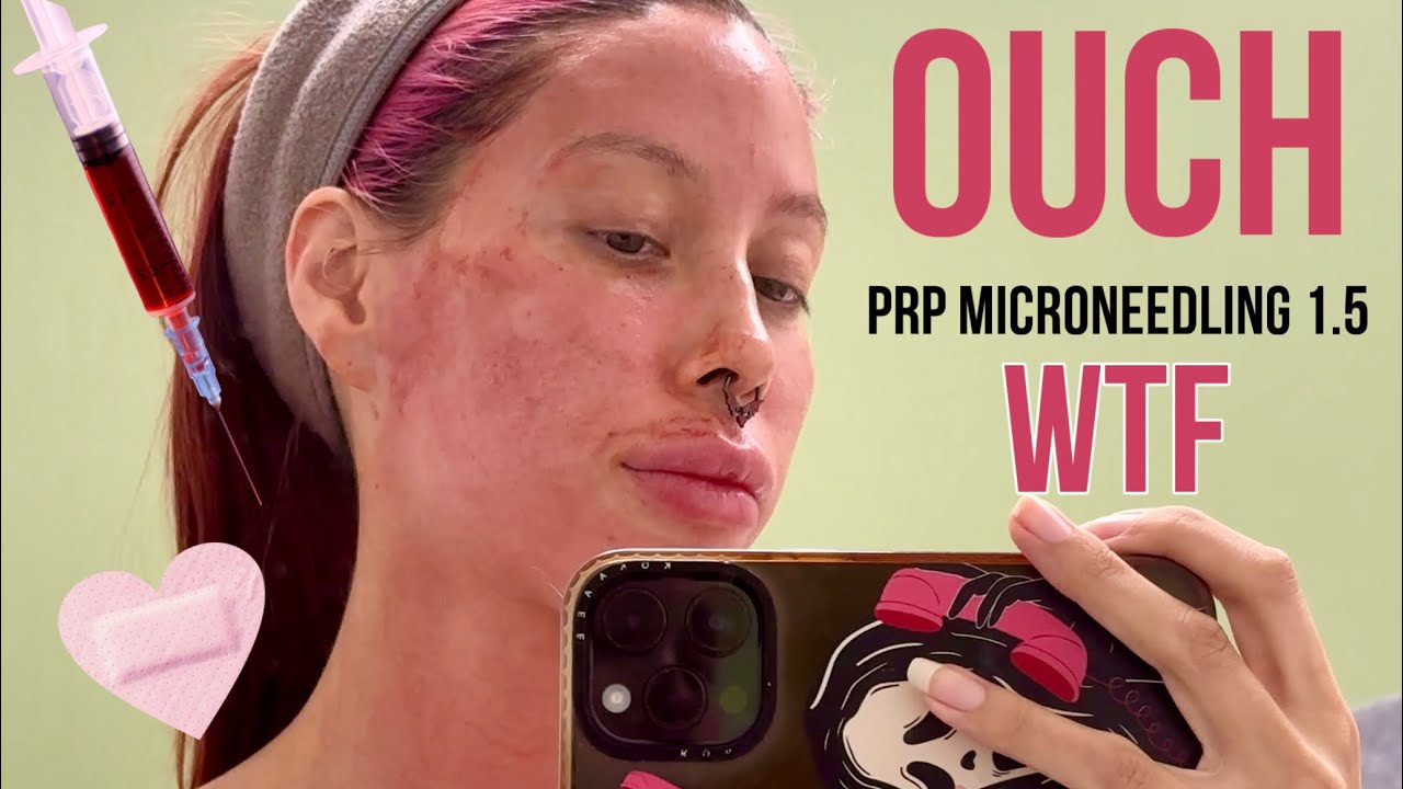 PRP Microneedling Facial Take 2 | WTFox Vlog x54 - YouTube