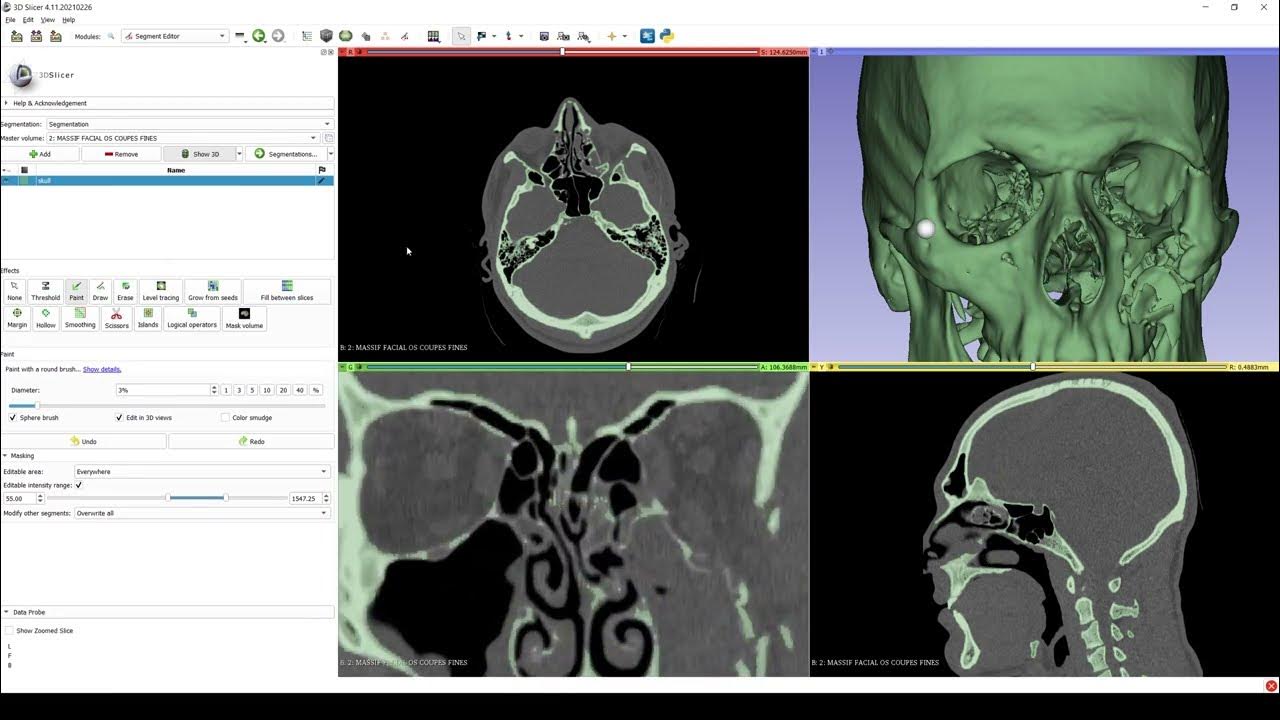 Part 1 - Using 3D Slicer to create a human skull and orbit model from a CT scan - SIMPLE METHOD ...