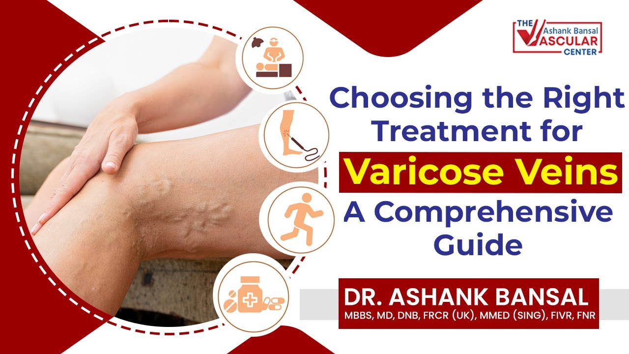 Choosing the Right Treatment for Varicose Veins | A Comprehensive Guide ...