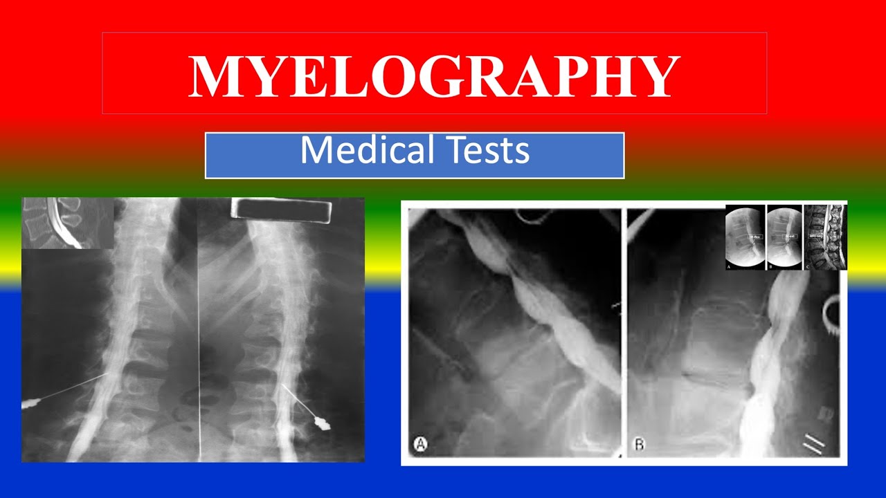 MYELOGRAPHY- - Medical Tests - What is ? , Uses , Need , Preparation ...