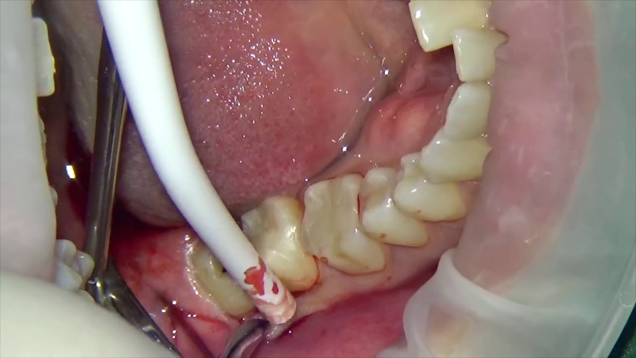 #48 extraction - YouTube