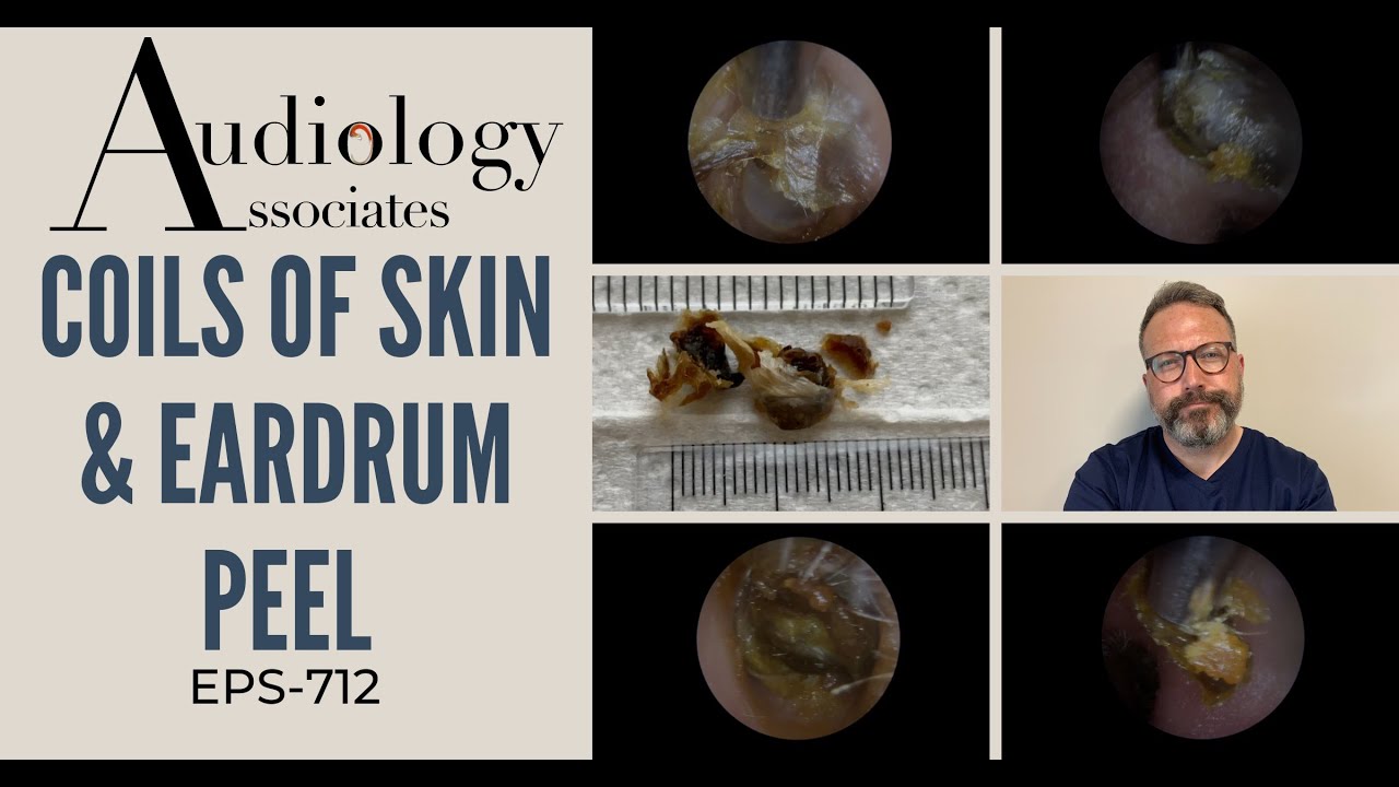 COILS OF SKIN & EARDRUM PEEL - EP712 - YouTube