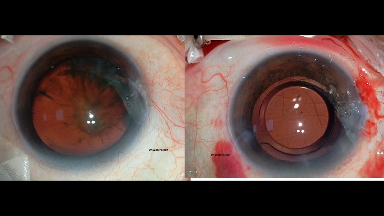 Direct Chop Phaco With Tecnis Eyhance IOL (Unedited) HD - YouTube