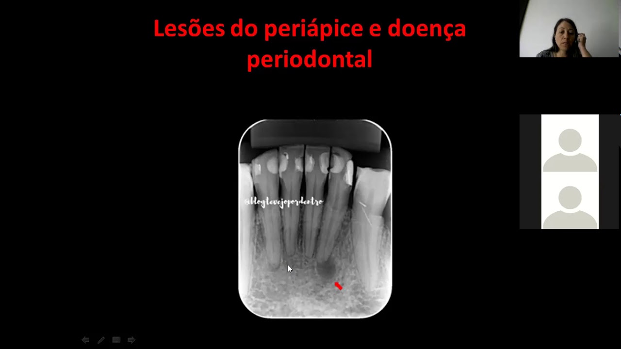 AULA PRÁTICA DE LESÕES DO PERIÁPICE E DOENÇA PERIODONTAL parte 01 - YouTube