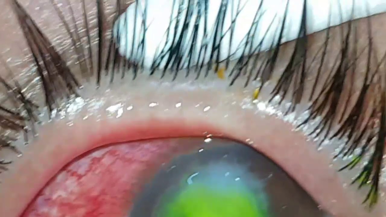 Absceso Corneal Severa por Cuerpo extraño Metalico - YouTube