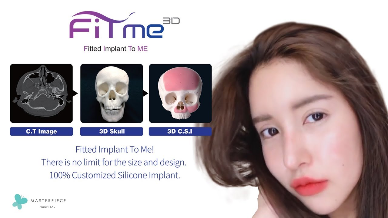 Vlog - Fitme 3D Customized Forehead Silicone Implant By Masterpiece Hospital - YouTube