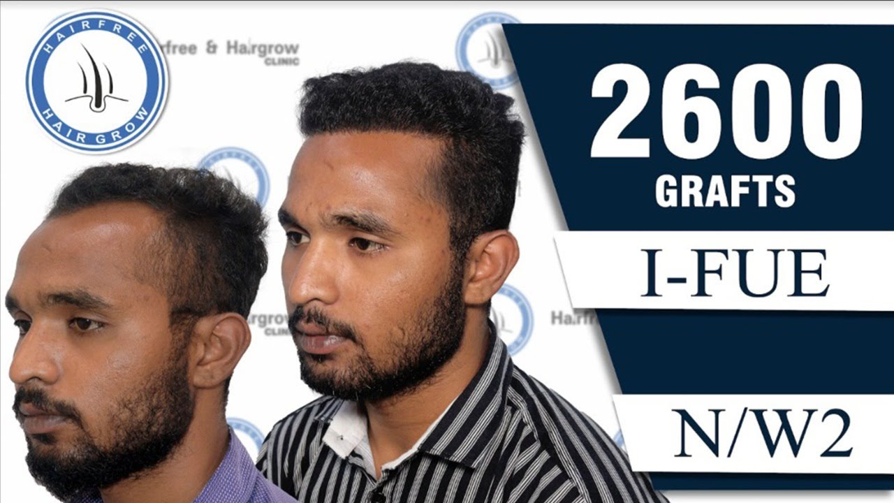 NW2 Hair Transplant Result | Surgery at @Hairfree & Hairgrow Hair Transplant Clinic Surat Branch ...