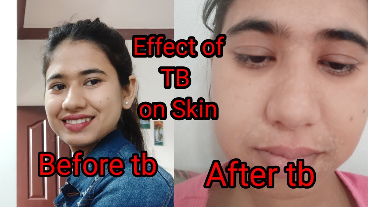 Side effects of TB on skin. Tuberculosis treatment side effects.Life of ...