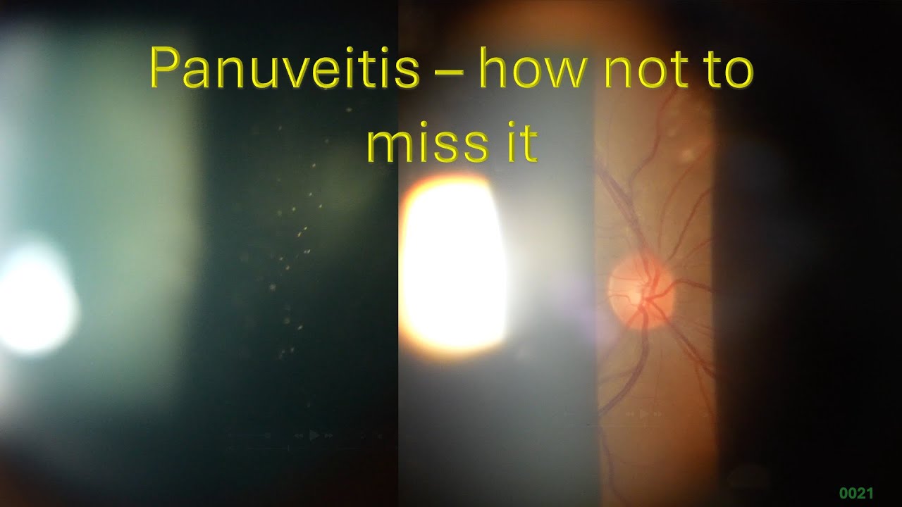 0021: Panuveitis - how not to miss it - YouTube