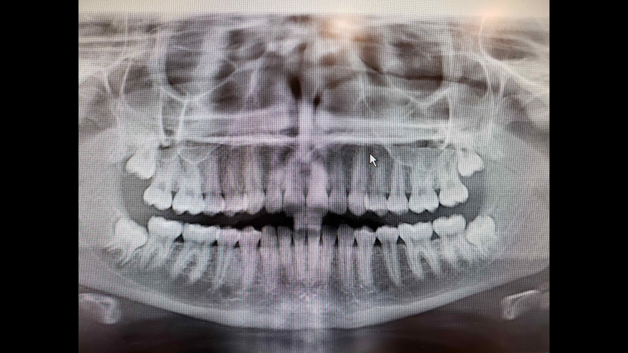 Step by Step demonstration of impacted Wisdom teeth (all 4) extraction ...