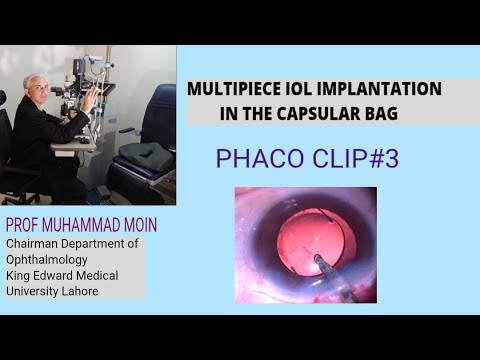 Alcon Multipiece IOL Implantation - YouTube