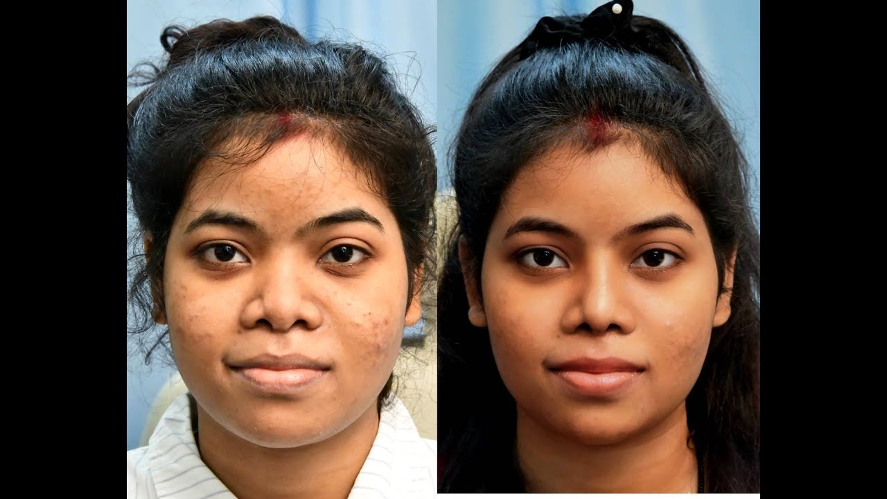 Flat nose (Binder's Nose)with under projected Tip 3-D reconstruction ...