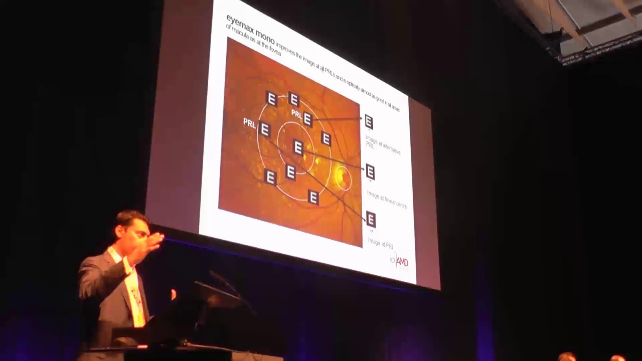 Dr Bobby Qureshi eyemax mono symposium Lisbon 2017 - YouTube