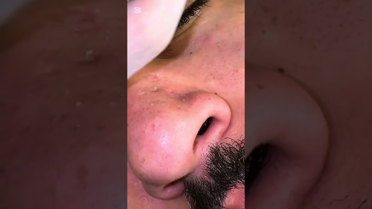 Skin blemishes and removal - YouTube