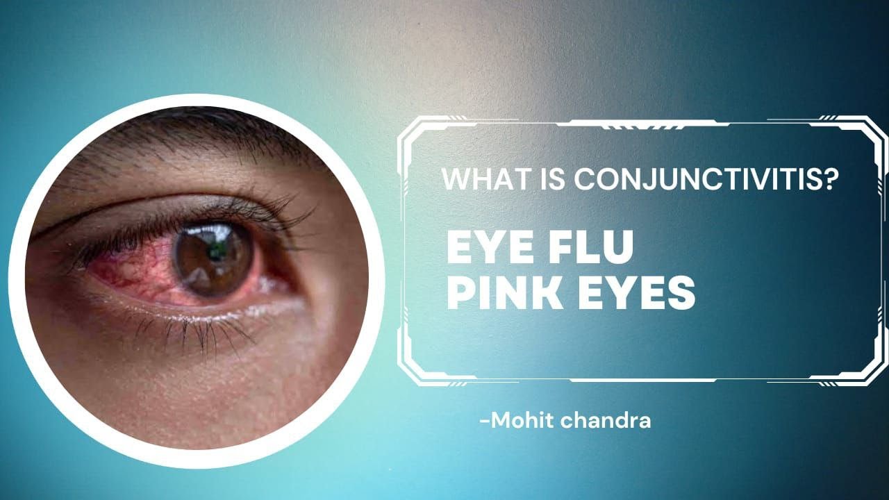 What is Conjunctivitis / pink eye / eye flu: UPSC CSE | Mohit Chandra ...