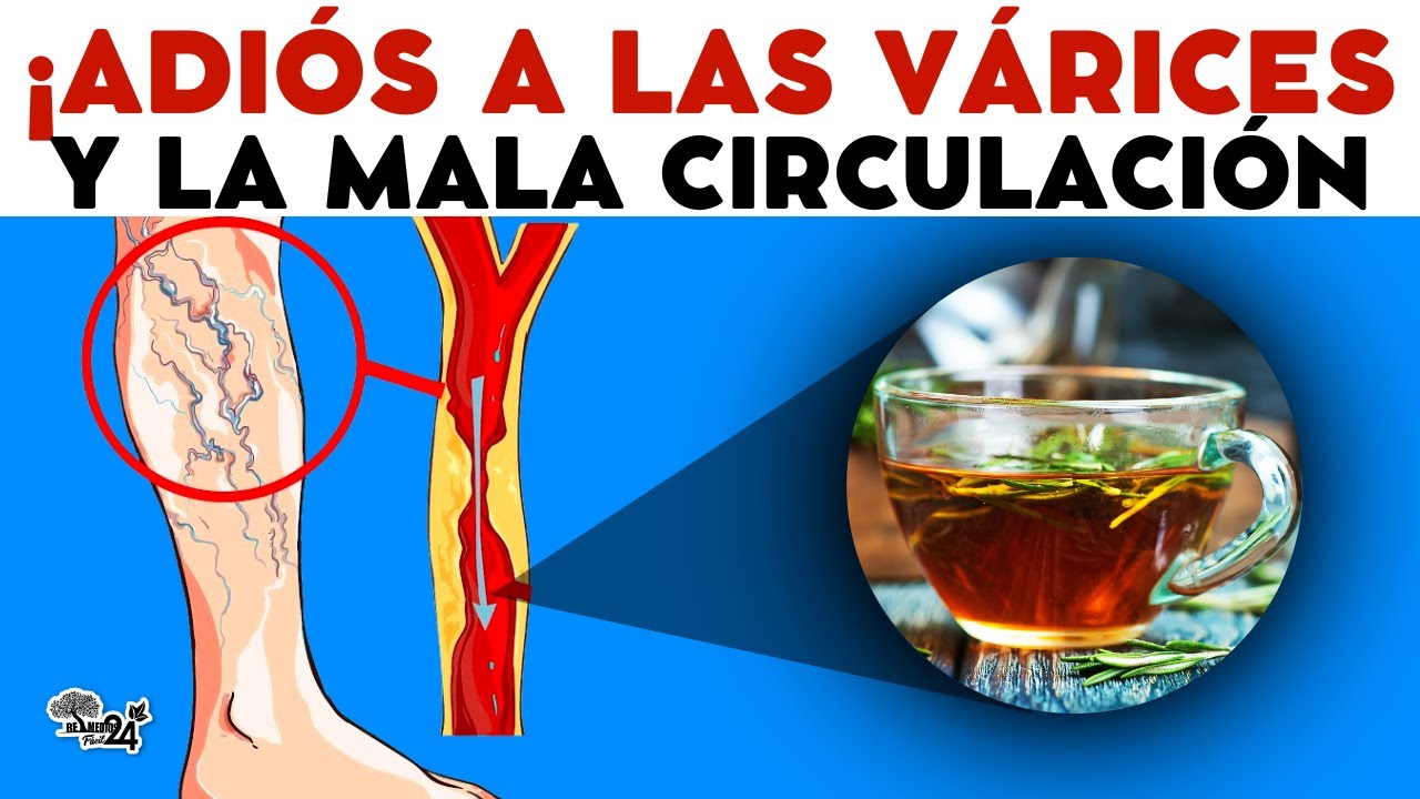 ¡ADIÓS A LAS VARICES Y LA MALA CIRCULACIÓN PARA SIEMPRE! Con este ...