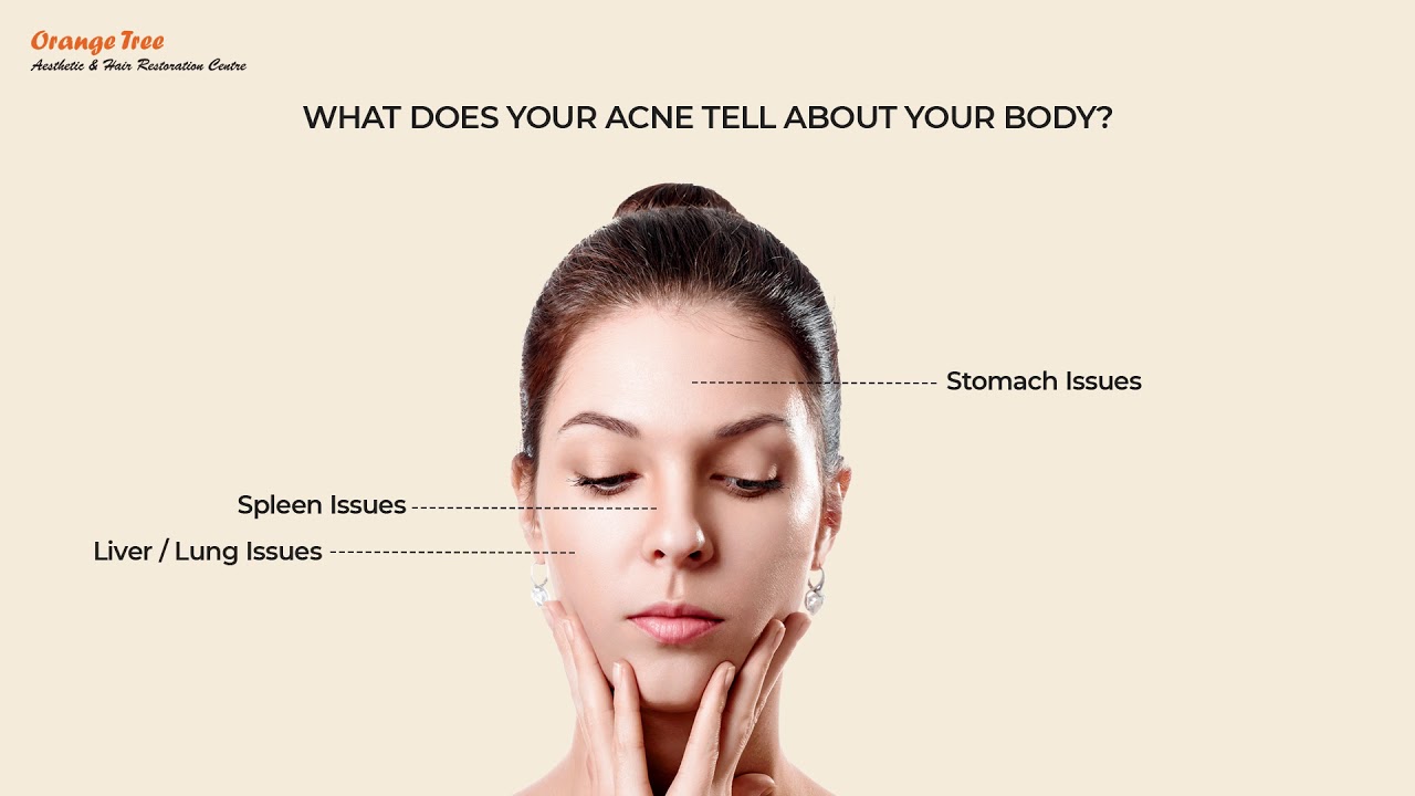 #ACNE, CAUSES, TYPES AND CURE. ORANGE TREE HEALTH TREATMENTS FOR ACNE ...