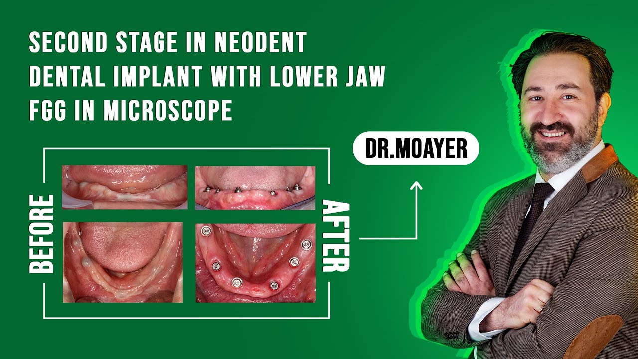 Second stage in Neodent dental implant with lower jaw FGG in microscope ...