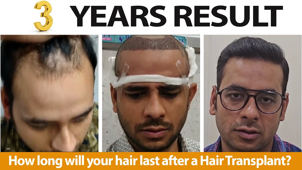 3 year after hair transplant | How long will your hair last after Hair ...