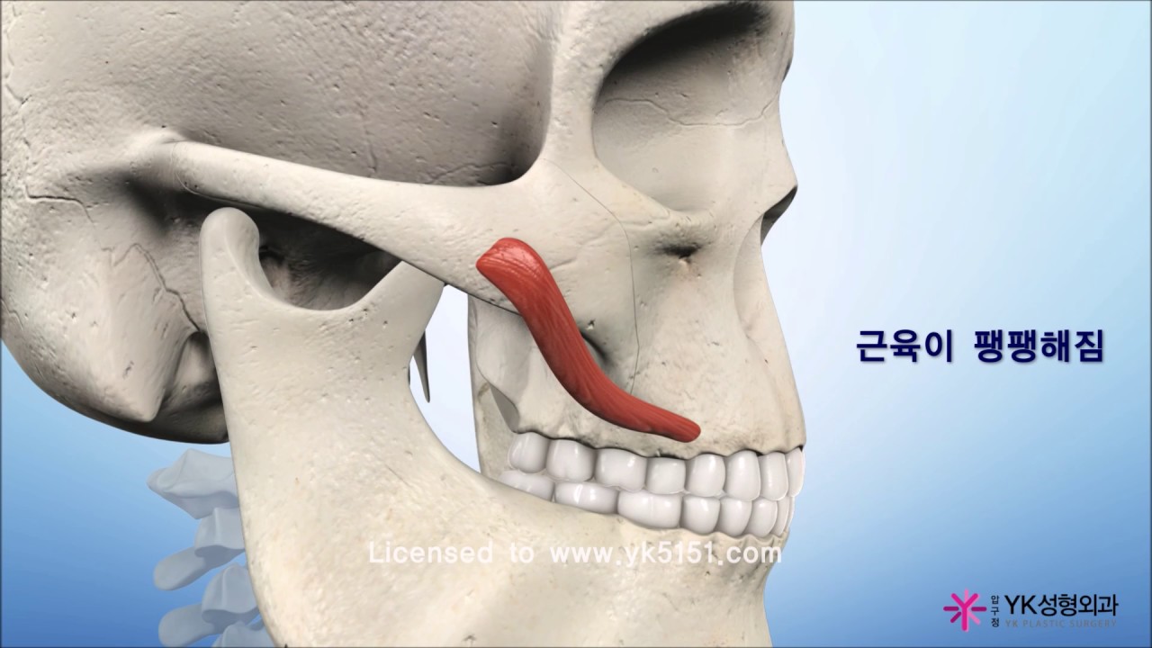 Malarplasty, Zygoma, Cheek bone, 광대, 광대성형, 리프팅 광대 - YouTube