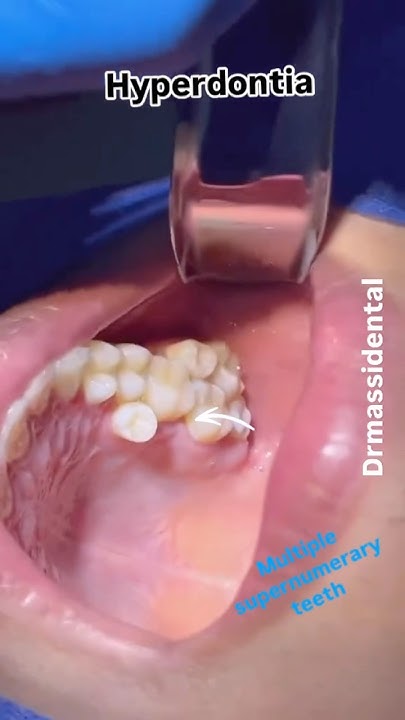 Hyperdontia, supernumerary teeth, Halloween, - YouTube