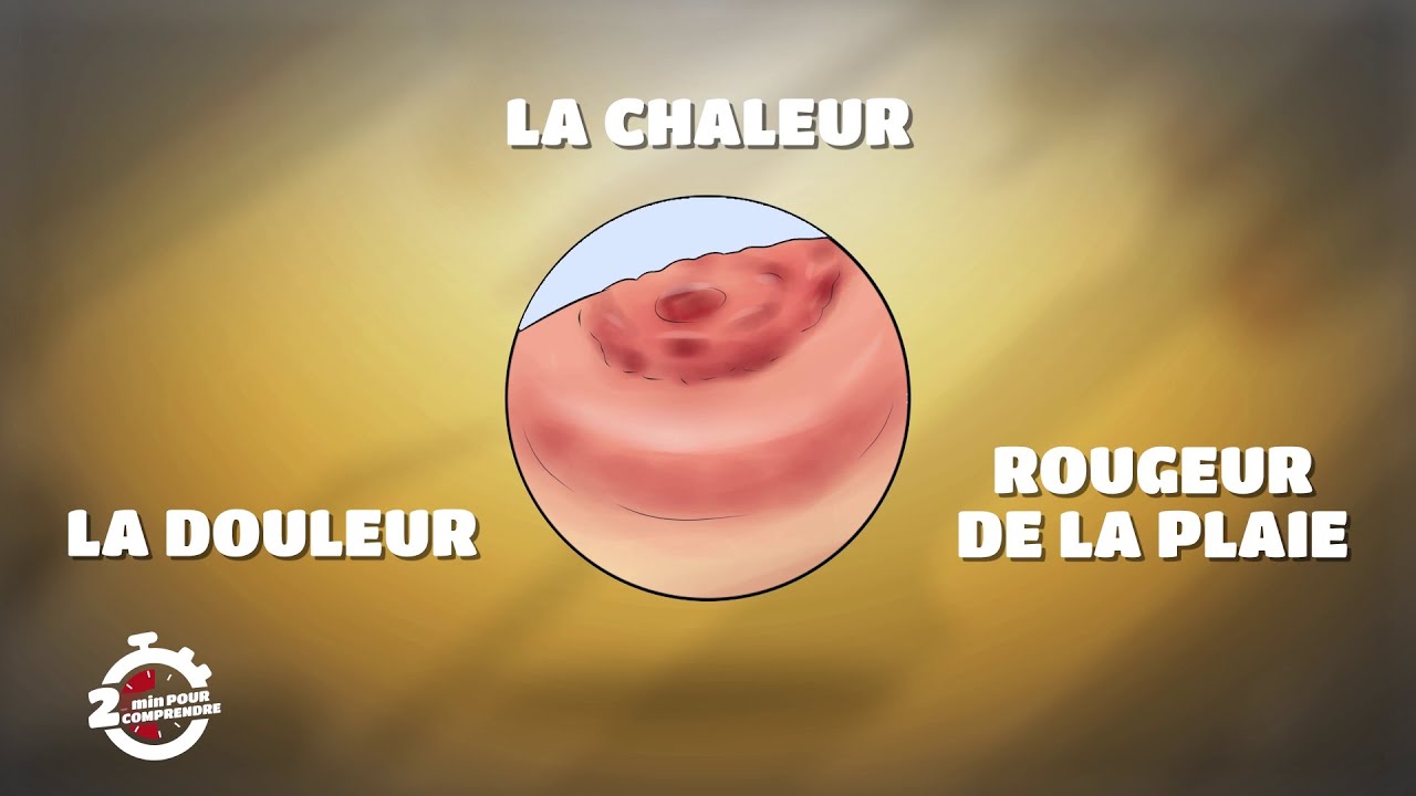 L'infection d'une plaie du 16 Août 2021 - YouTube