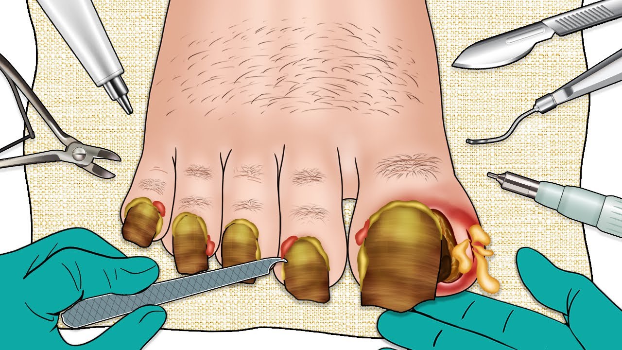[ASMR] Treat toenail popping, toenail fungus and repair broken toenails ...