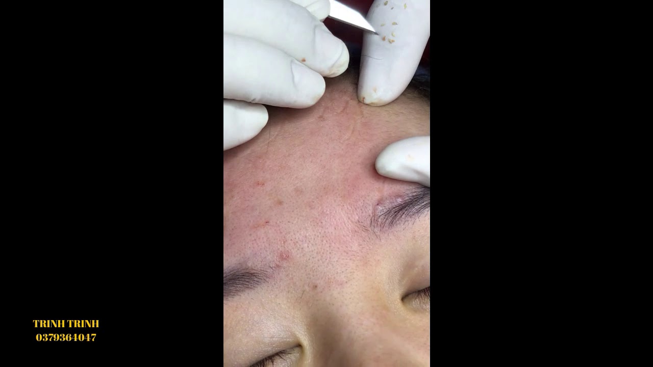 Squeeze Blackheads, Whiteheads| ACNE TREATMENT| NẶN MỤN ĐÚNG CÁCH - NẶN ...